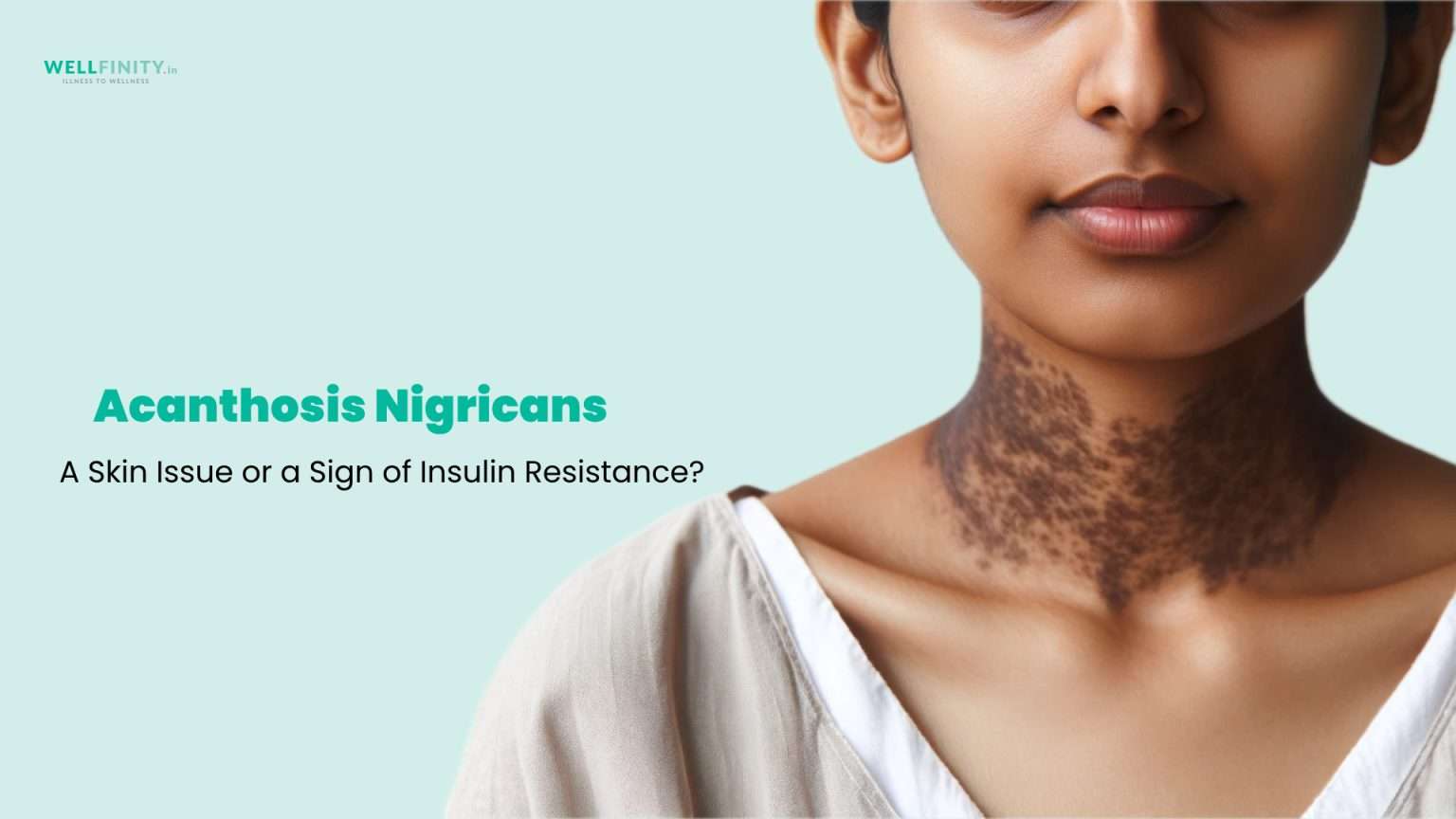 Acanthosis Nigricans: A Skin Issue or a Sign of Insulin Resistance ...